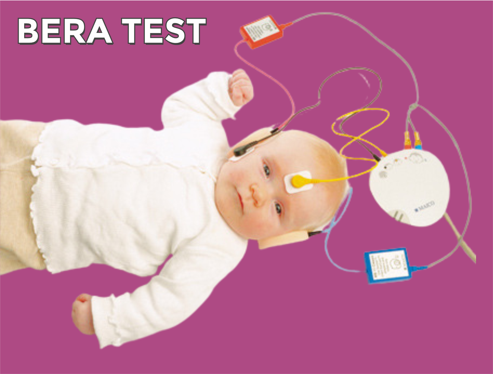 BERA Test in Neonatal Hearing Screening - Everythingnow